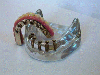 Protocolo Branemark :: ::::::::::::: CPD - Prótese Odontológica
